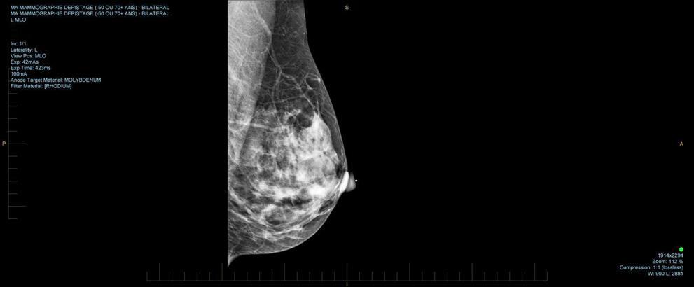 Aşılamaya bağlı lenf bezi tutulumu meme kanseriyle karıştırılıyor ...