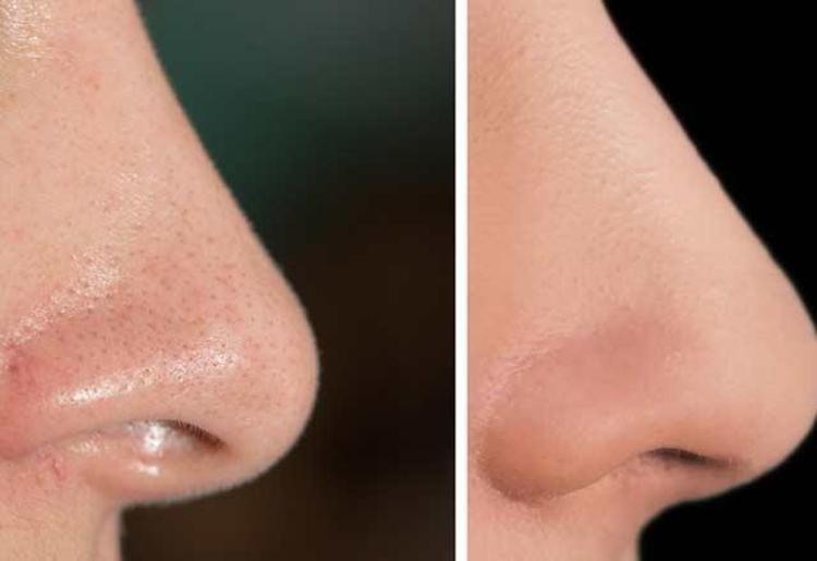 Evde hazırlayabileceğiniz basit maske tarifleri - Cilt Bakımı