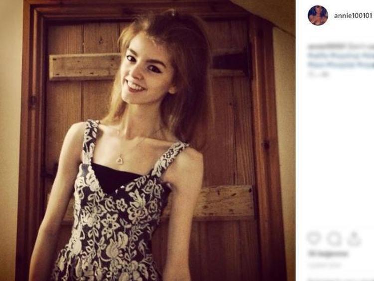 Anoreksiya hastalığına yakalanmıştı, şimdi ise bambaşka biri! - Dünya ...