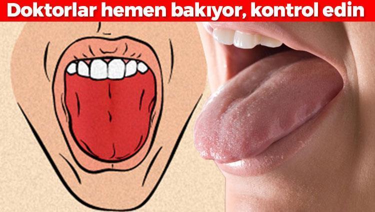 Kırmızı dil rengi bu hastalığın işareti! Doktorlar bu yüzden bakıyormuş ...