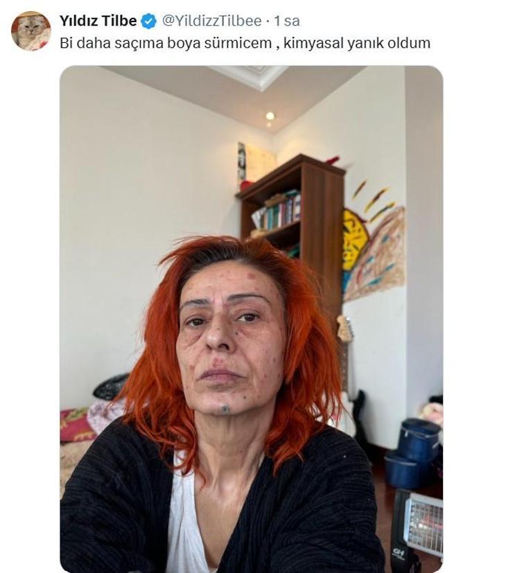 Yüzünde kimyasal yanıklar oluşmuştu! İşte Yıldız Tilbe'nin son hali ...
