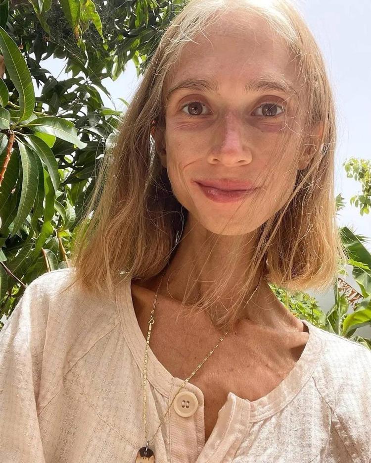 22 kiloya kadar düşen sosyal medya fenomeni Karolina Krzyzak hayatını kaybetti - Magazin ...